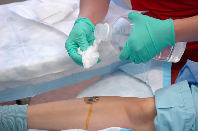 Houston Center for Infectious Diseases | Wound Care