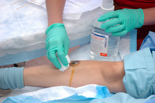 Houston Center for Infectious Diseases | Wound Care